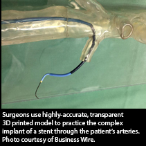 3D patient specific models prove integral to life saving vascular surgery.