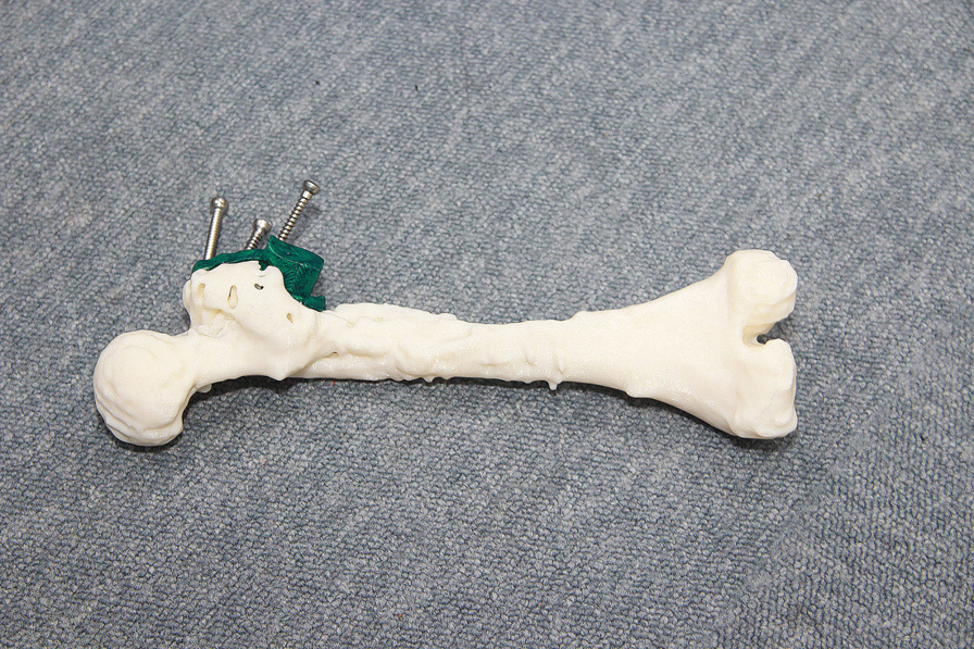 3D Models Improve Hospital's Orthopaedic Surgeries
