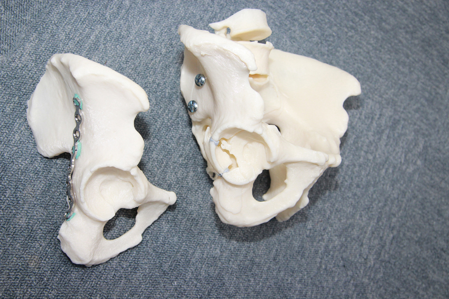 3D Models Improve Hospital's Orthopaedic Surgeries