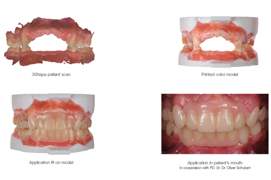 Dental Laboratory LMU prints highly-accurate, full-color dental ...
