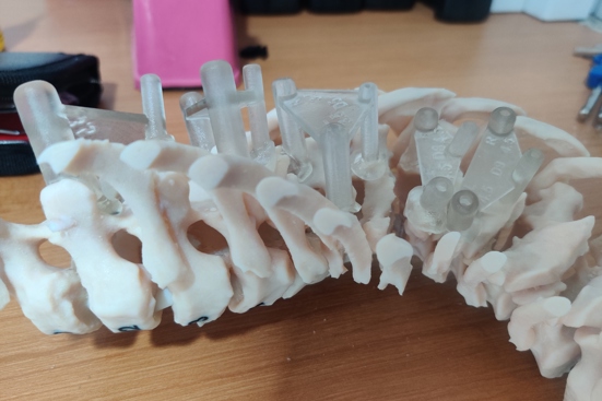 3D Printing Supports Treatment for Dorsal Scoliosis